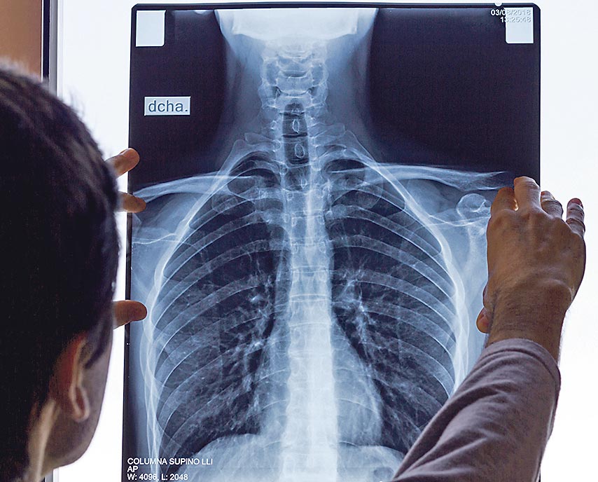 USPJEH KOD RANOG OTKRIVANJA RAKA PLUĆA: U dvije godine programa ...